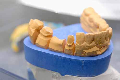 Patienteninfo: Ein Backenzahn fehlt – was tun?: Dents.de